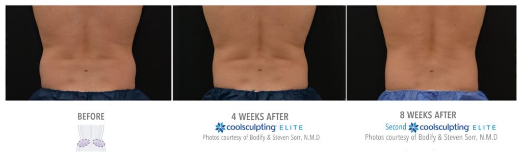 Coolsculpting Real Results in North Myrtle Beach, SC